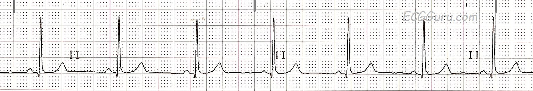 ECG Basics: Normal Sinus Rhythm | ECG Guru - Instructor Resources